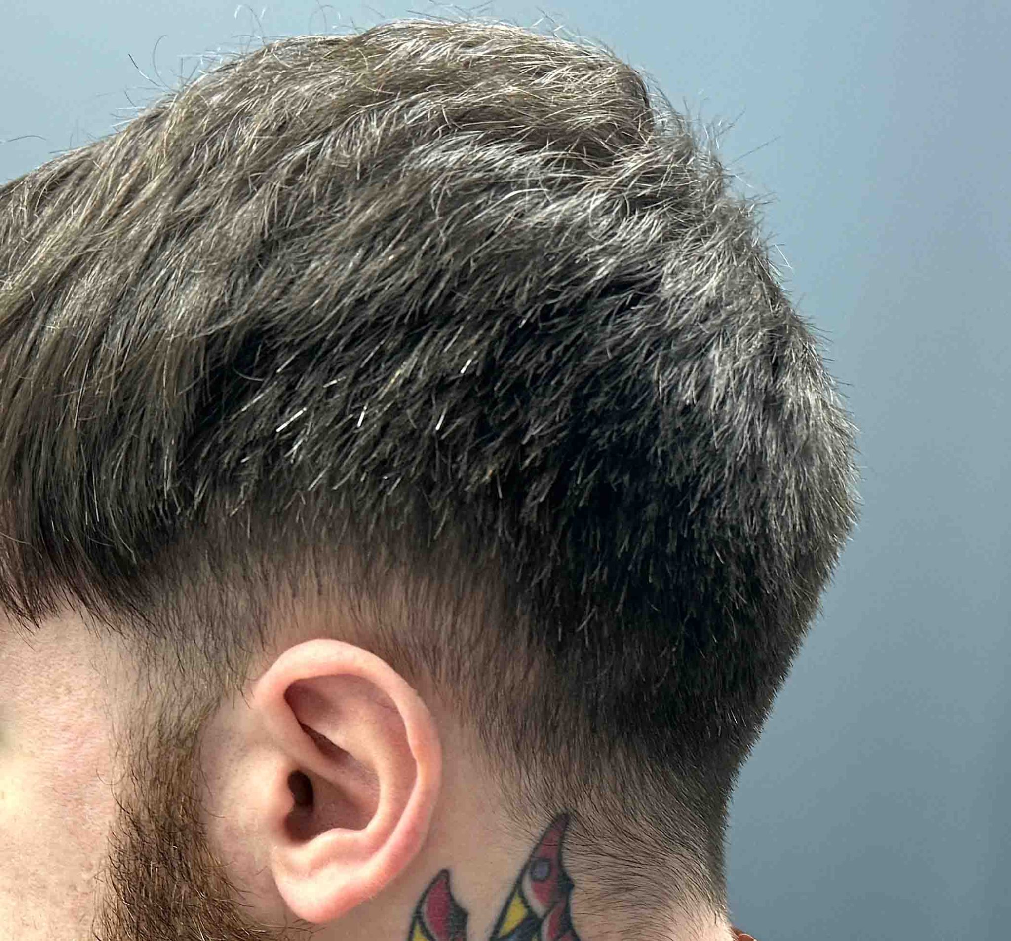 Plastic Surgery Case Study - Male Occipital Bun Deformity Reduction ...
