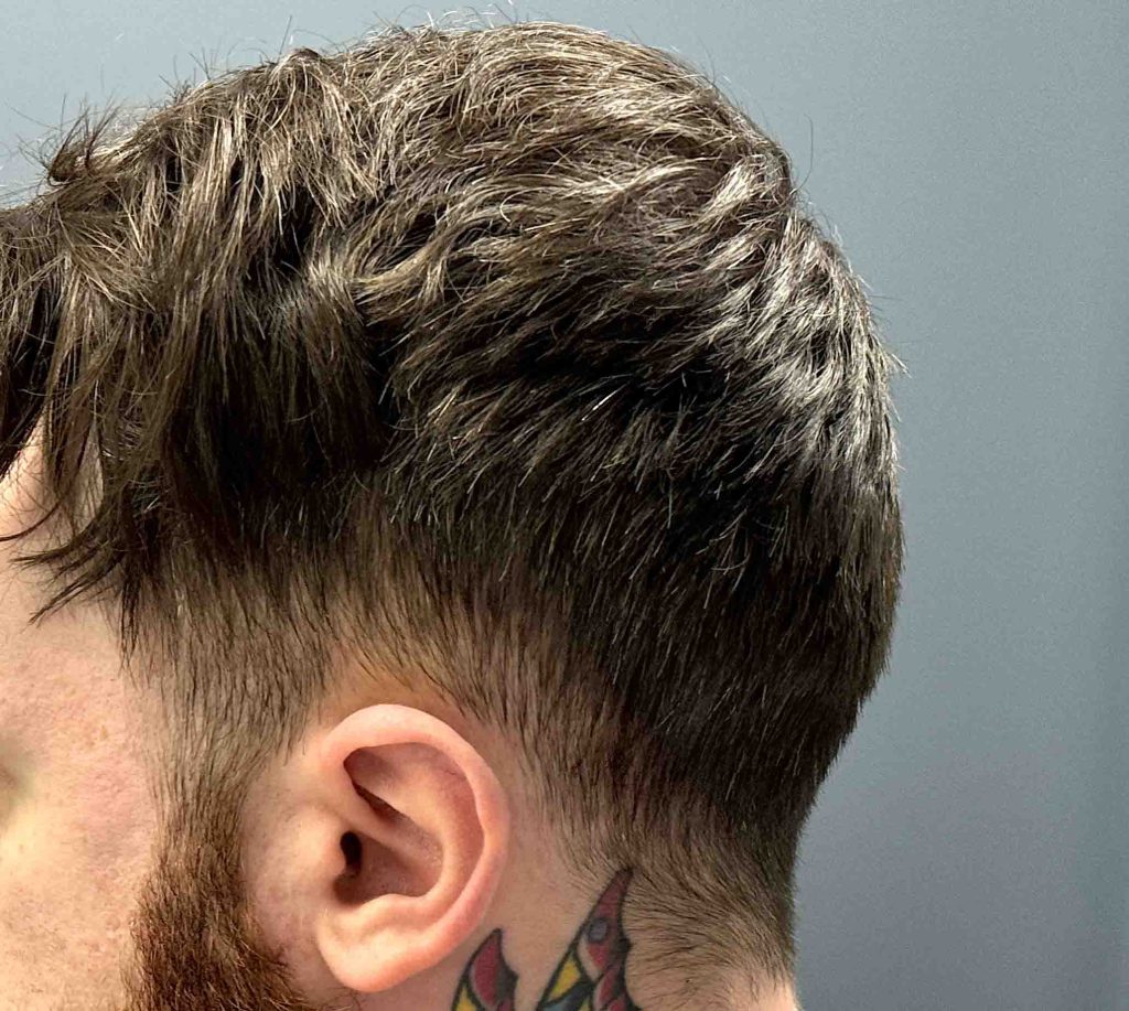 Plastic Surgery Case Study - Male Occipital Bun Deformity Reduction ...