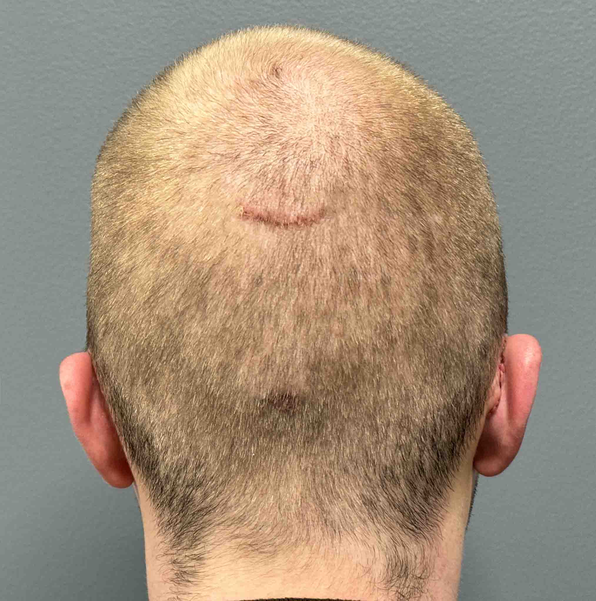 male temporal reduction back 2 Dr Barry Eppley - Explore Plastic Surgery