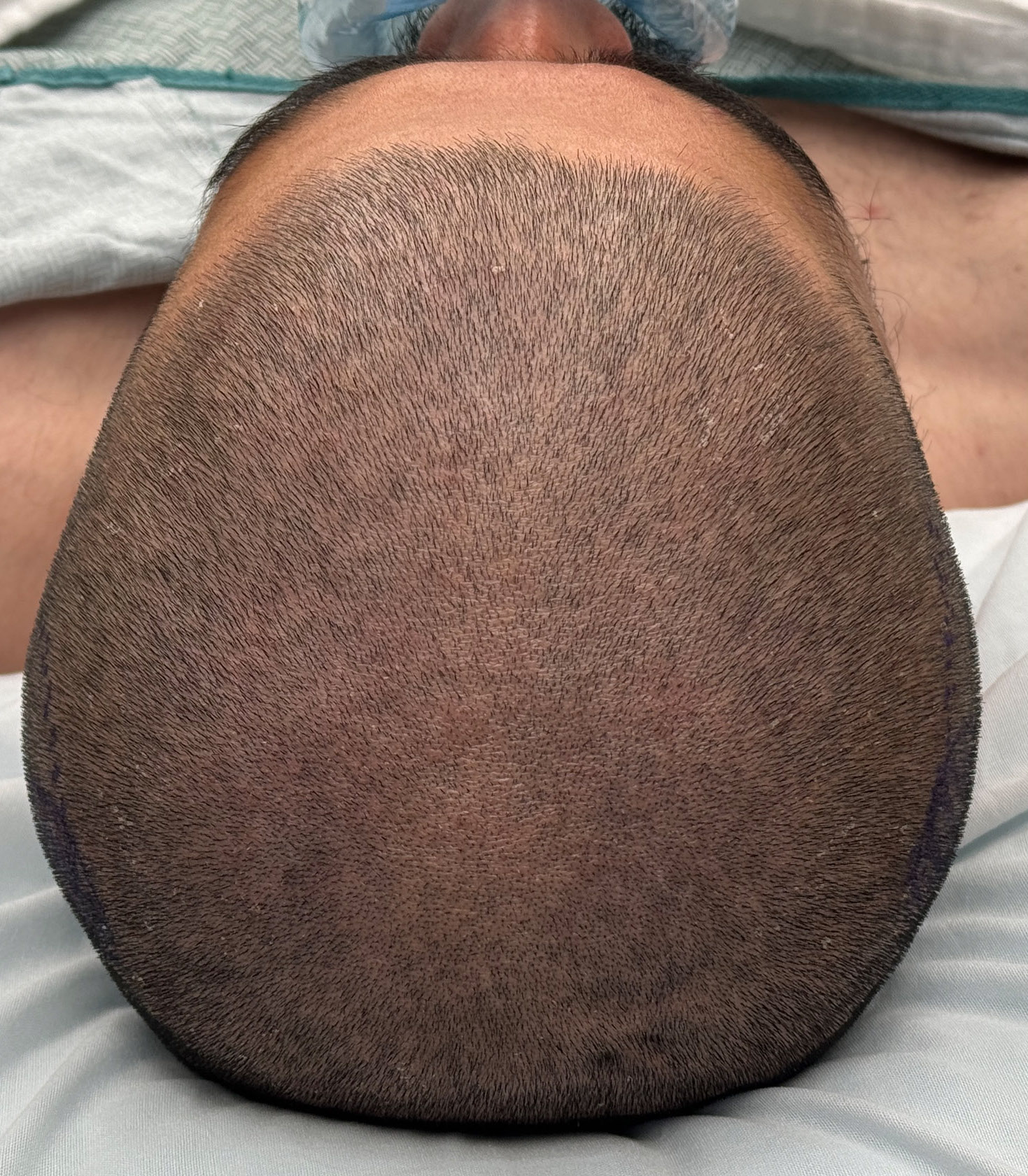 male temporal reduction top 1 DR Barry Eppley - Explore Plastic Surgery