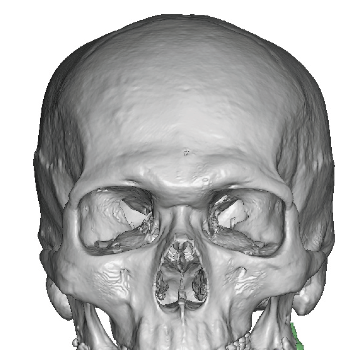 male upper facial deficiency 3D Ct scan front view Dr Barry Eppley ...