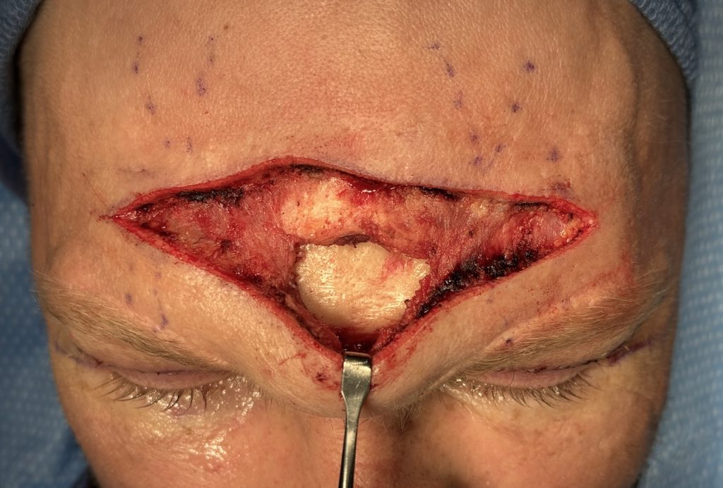 Plastic Surgery Case Study - Mid-Forehead Lift in the Male with Central ...