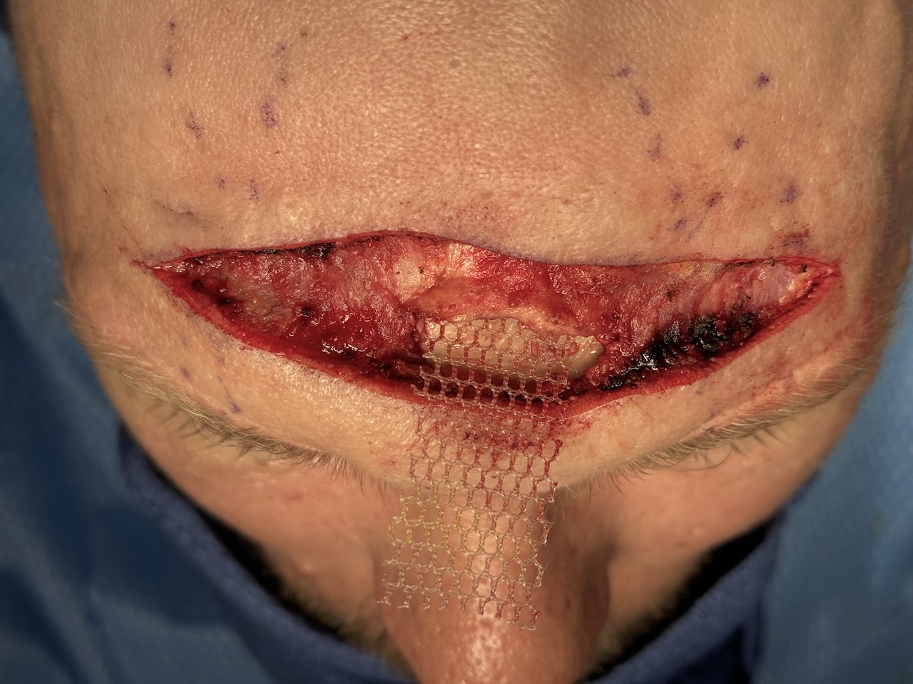 mid-forehead lift mesh implant Dr Barry Eppley - Explore Plastic Surgery