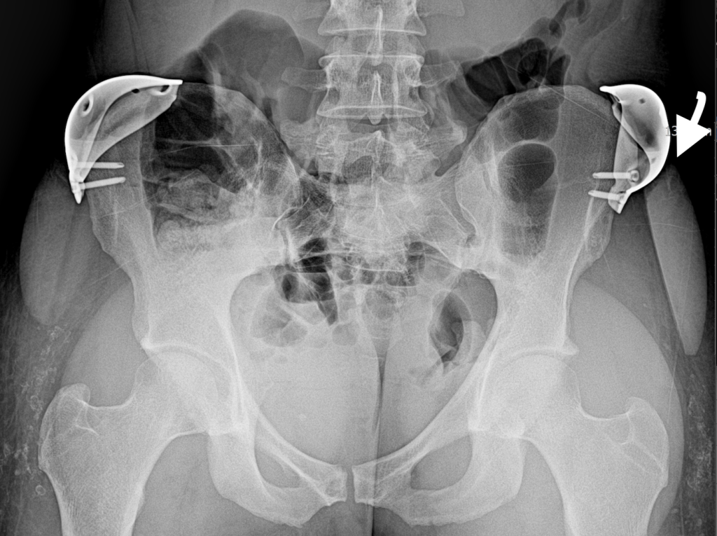 Pelvic Plasty - 4. The Sub Iliac Plate Hip Dip Implant - Explore ...