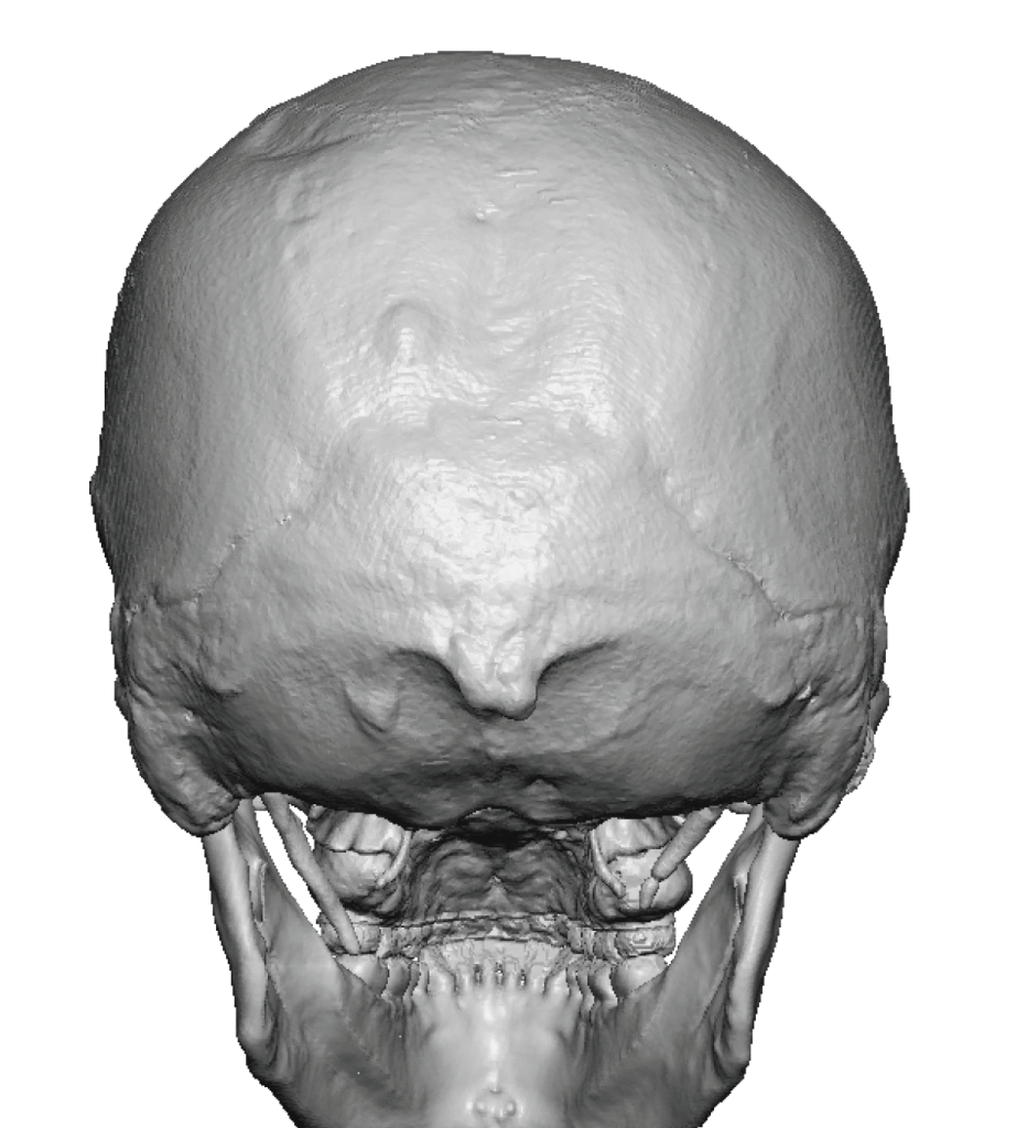 multi surface area skull irregularities 3D CT scan back view Dr Barry ...