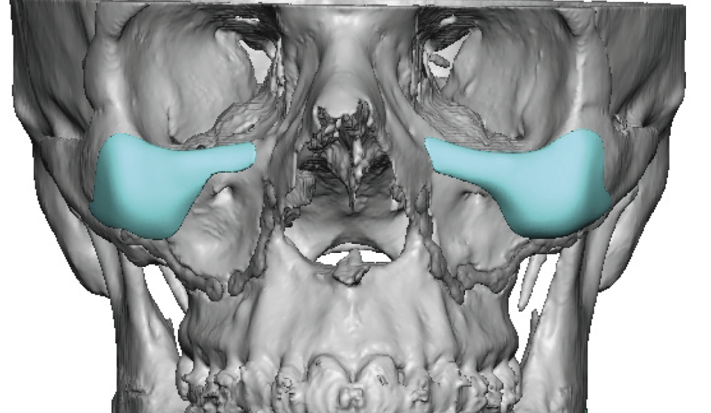 new custom IOM implant design front view Dr Barry Eppley - Explore ...