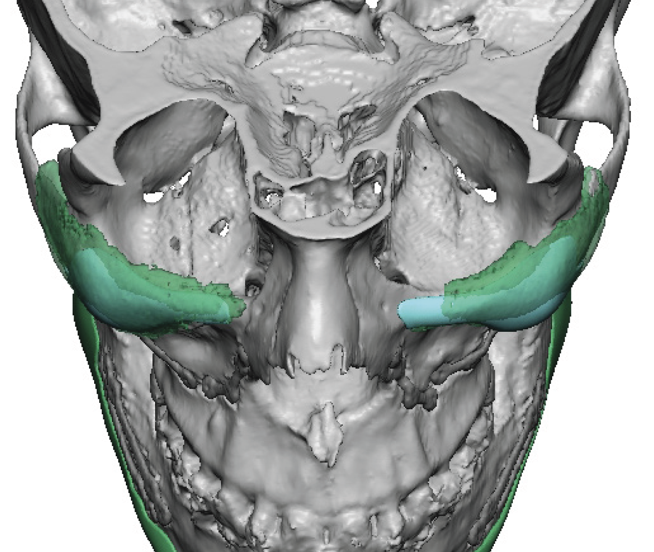 Plastic Surgery Case Study - Long Term Replacement of Custom ...