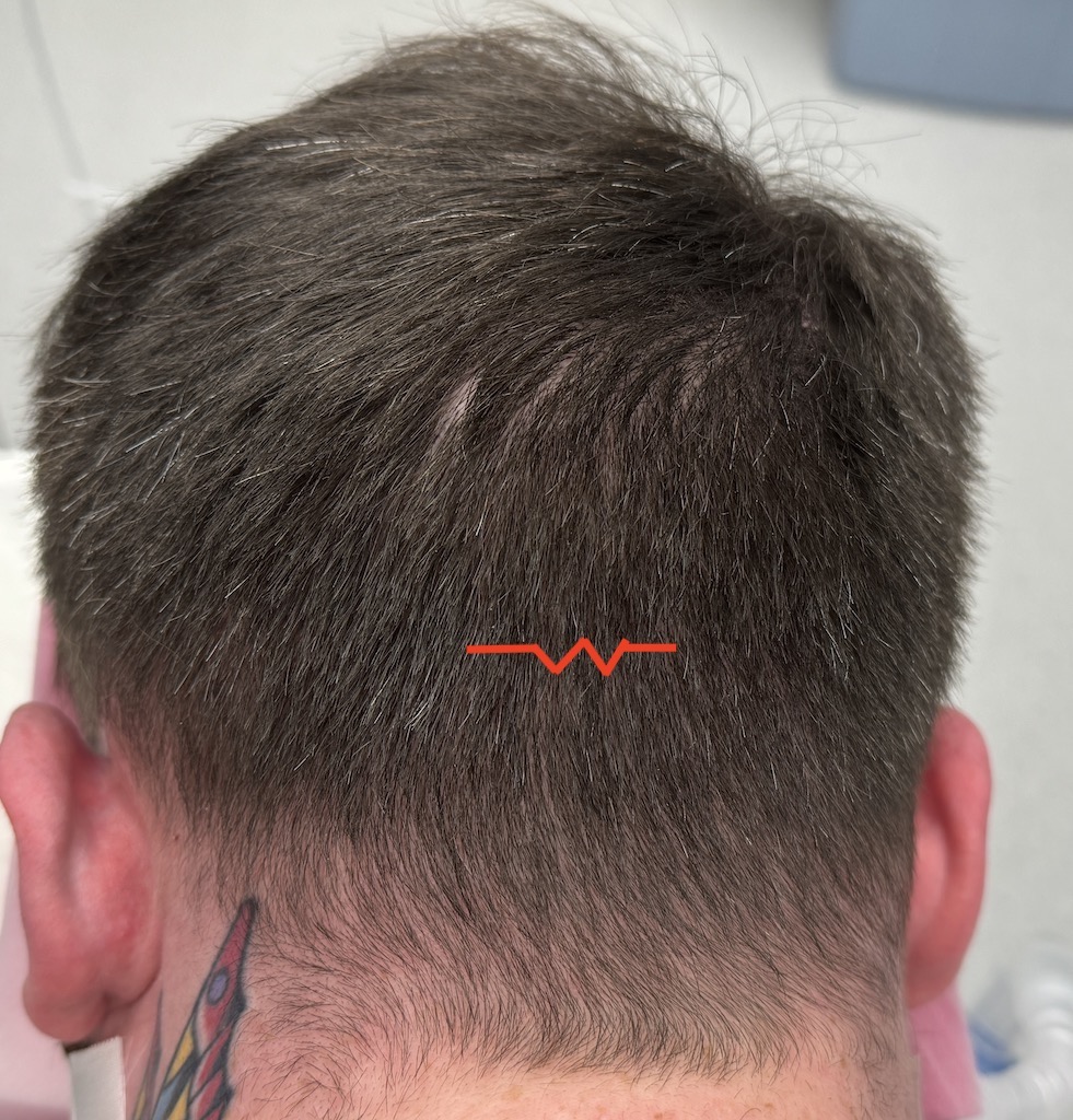 occipital skull reduction incision Dr Barry Eppley - Explore Plastic ...