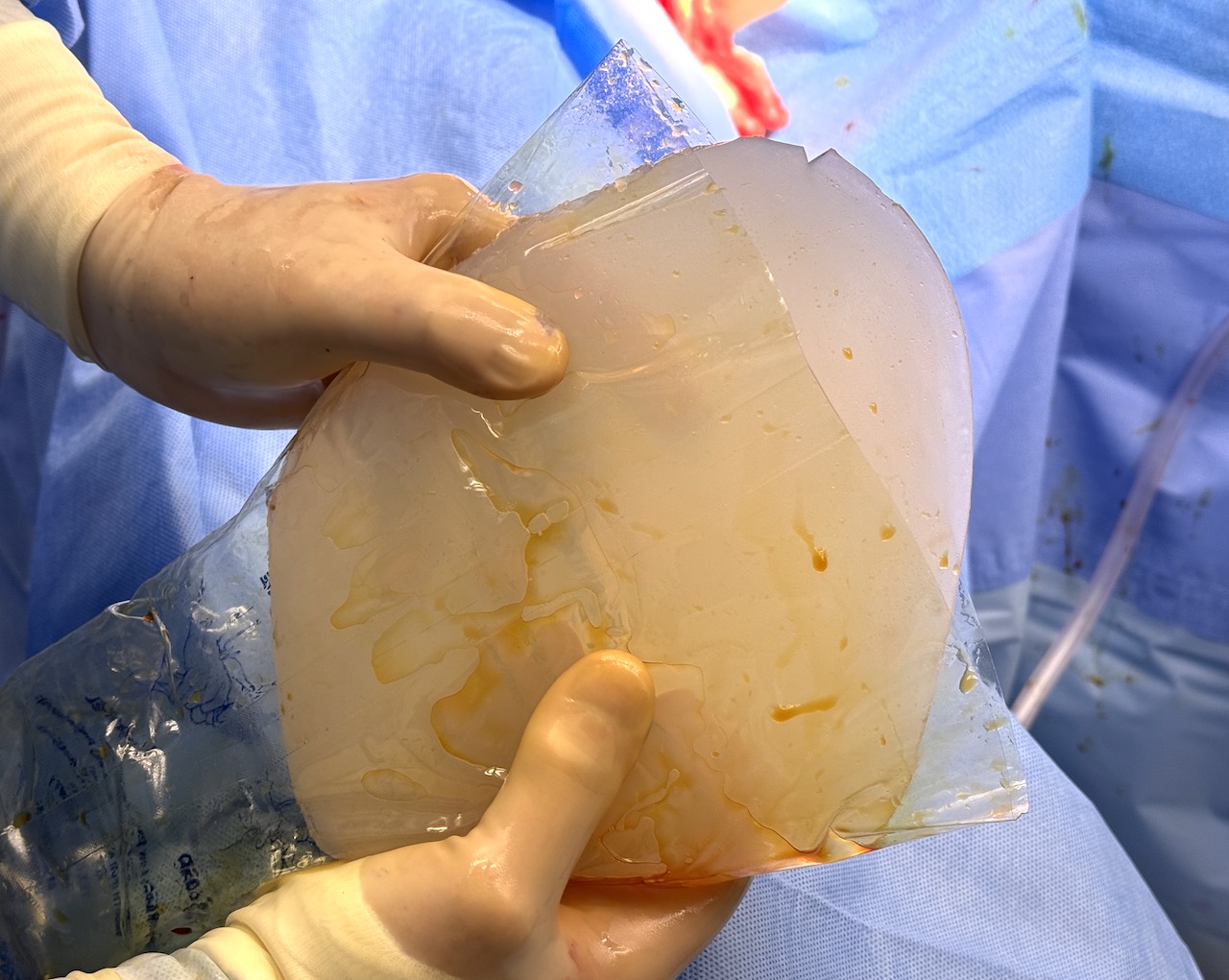 pectoral implant notch marker Dr Barry Eppley - Explore Plastic Surgery