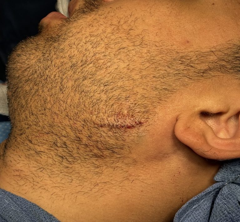 Technical Strategies - Direct Transcutaneous Approach to Jaw Angle ...