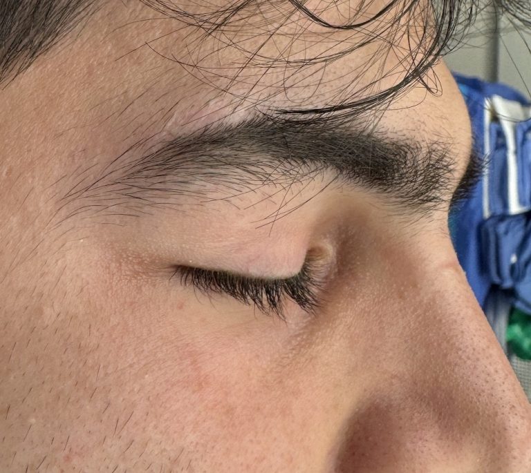 The Upper Eyelid Incision in Extended Custom Midface Implants - Explore ...