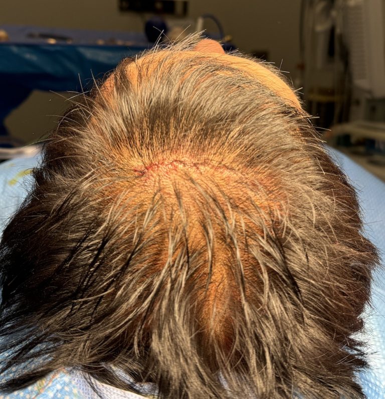 Plastic Surgery Case Study - Male Custom Forehead-Brow Bone Implant ...