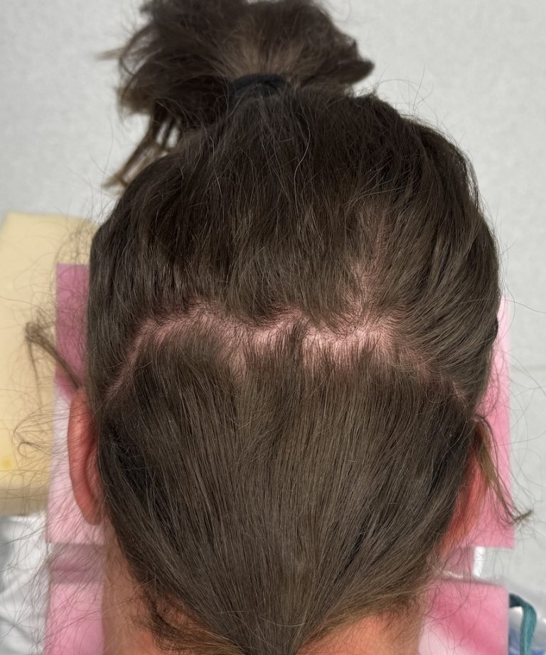 The 1st Stage Scalp Expander in Two Stage Large Skull Augmentations ...