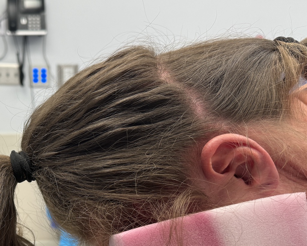 scalp tiisue expander intraop positioning side view Dr Barry Eppley ...