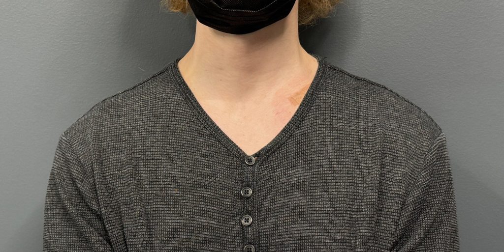 Plastic Surgery Case Study - The Use of A Wedge Bone Graft in Clavicle ...