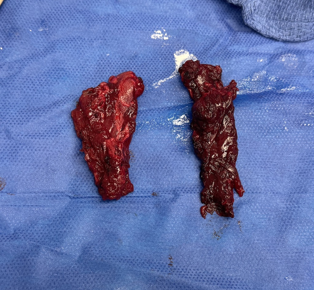 temporal muscle removal Dr Barry Eppley - Explore Plastic Surgery