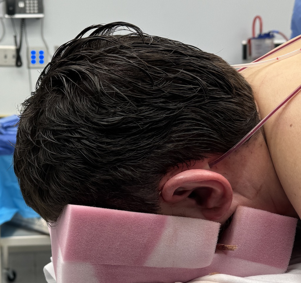 temporal reductions done in the prone position. Dr Barry Eppley ...