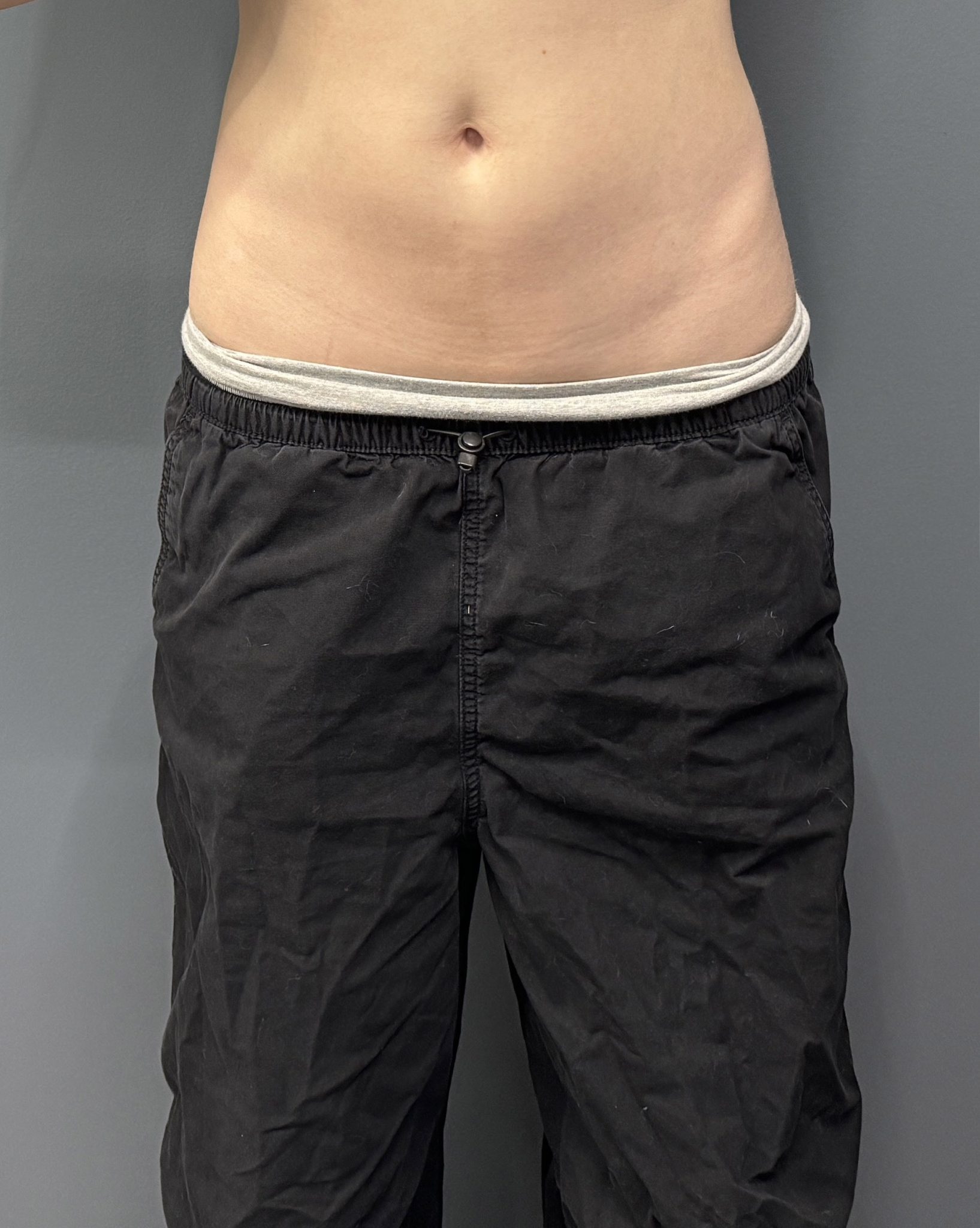 Plastic Surgery Case Study - Custom Hip Dip Implants - Explore Plastic ...