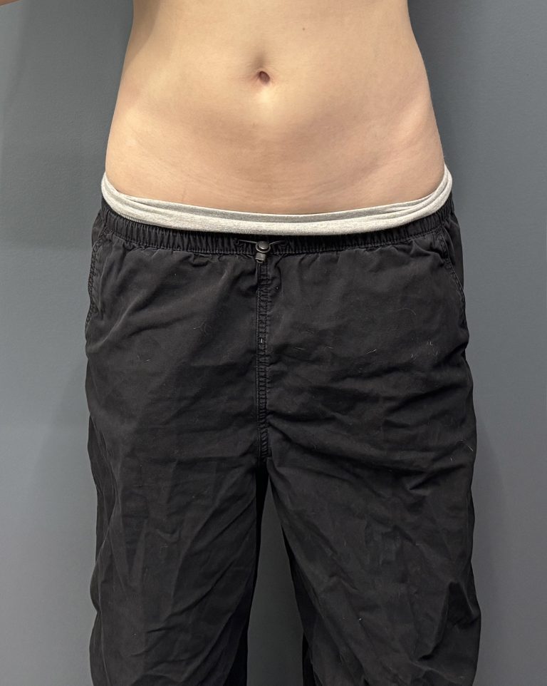 Plastic Surgery Case Study - Custom Hip Dip Implants - Explore Plastic ...