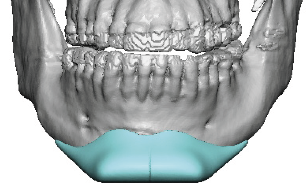 custom square chin implant design front view Dr Barry Eppley - Explore ...