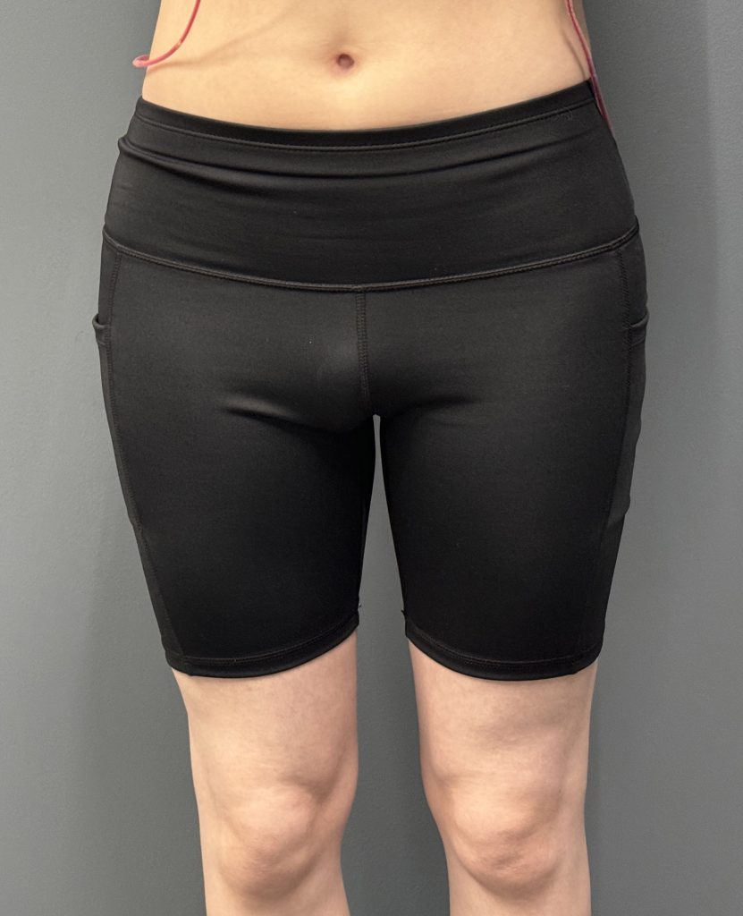 Plastic Surgery Case Study - Custom Hip Dip Implants - Explore Plastic ...