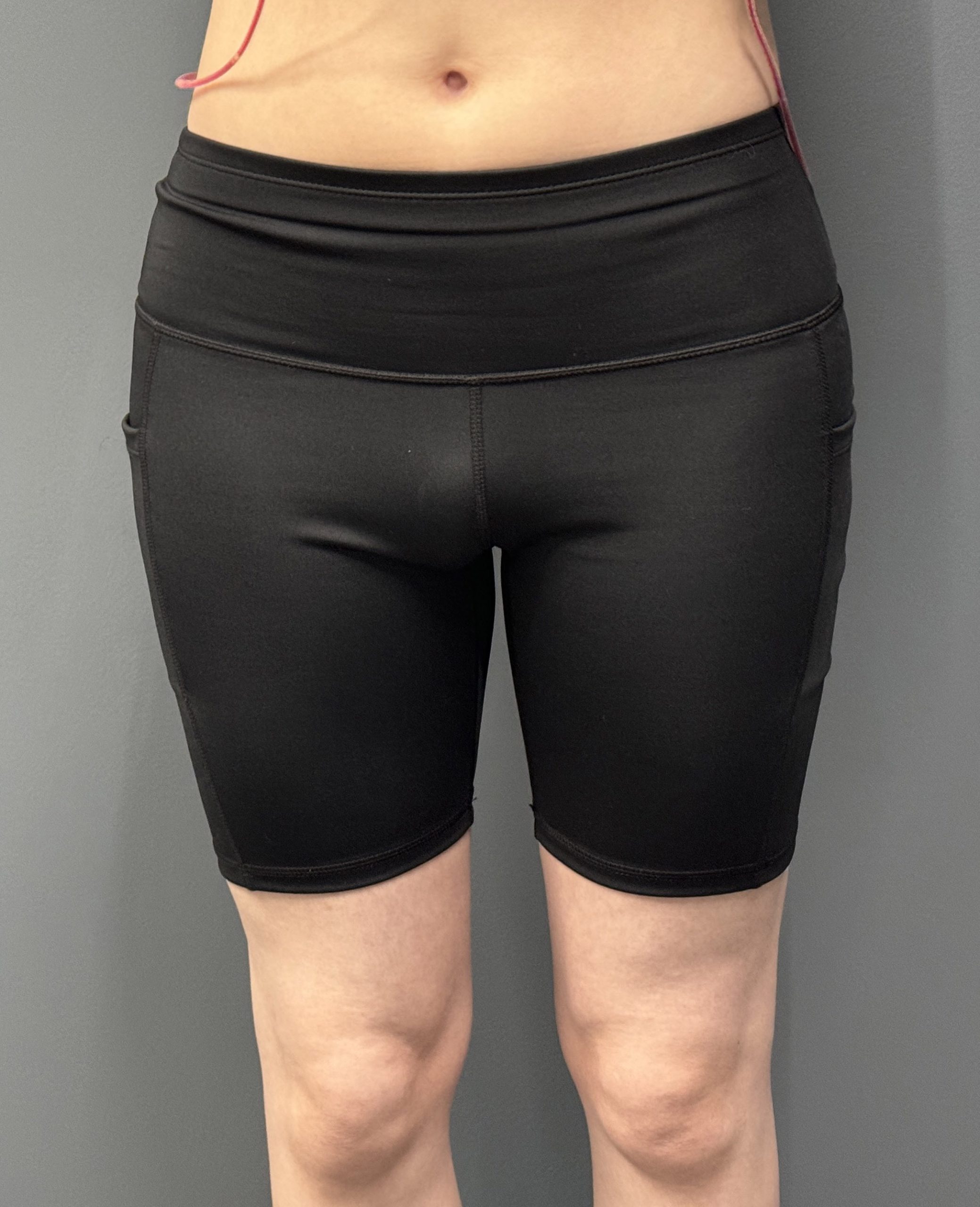 female custom hip implants front 2 Dr Barry Eppley - Explore Plastic ...