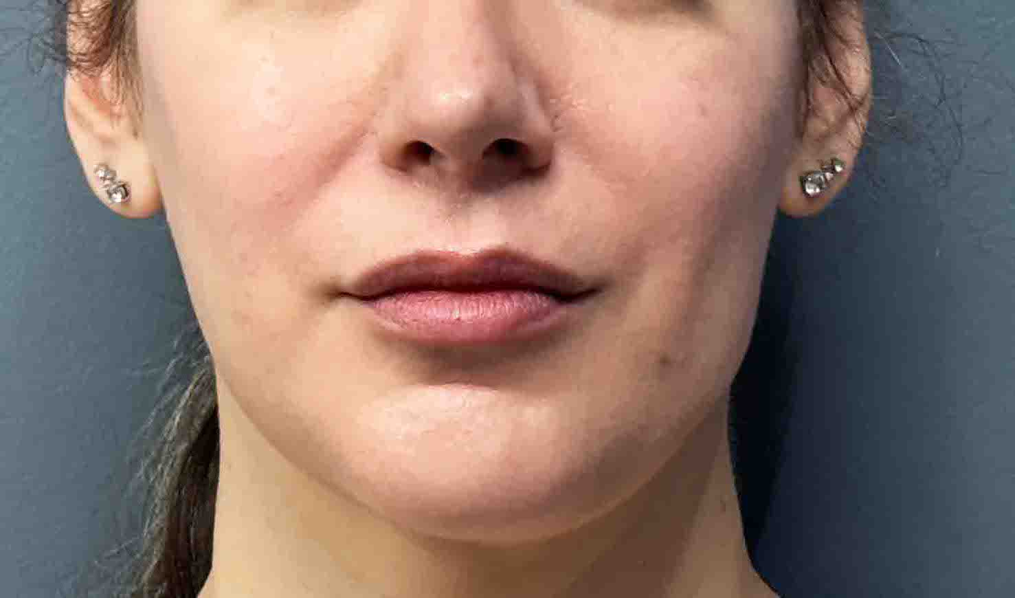 Plastic Surgery Case Study - Female Custom Jawline Implant for Subtotal ...