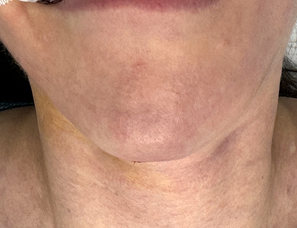 Plastic Surgery Case Study - Female Custom Chin Implant Replacement for ...