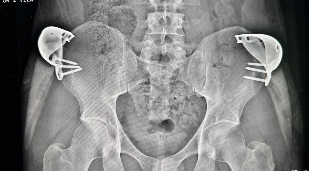 iliac crest + hip implants postop x ray Dr Barry Eppley - Explore Plastic Surgery