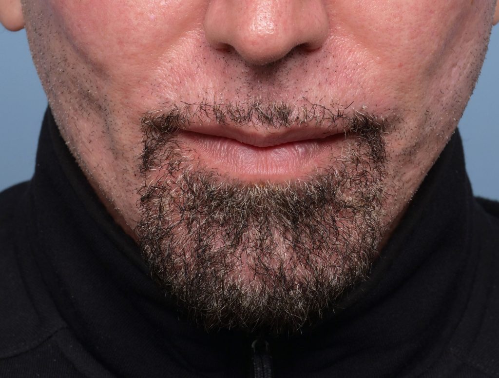 Plastic Surgery Case Study - Custom Chin Implant for Strong Squared ...