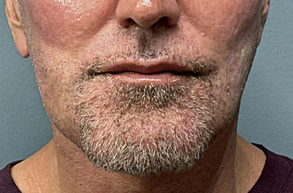 Plastic Surgery Case Study - Custom Chin Implant for Strong Squared ...