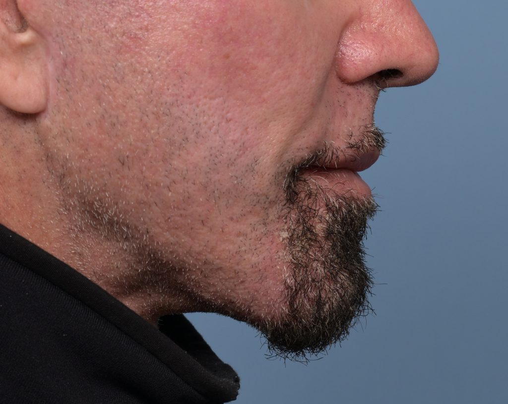 Plastic Surgery Case Study - Custom Chin Implant for Strong Squared ...