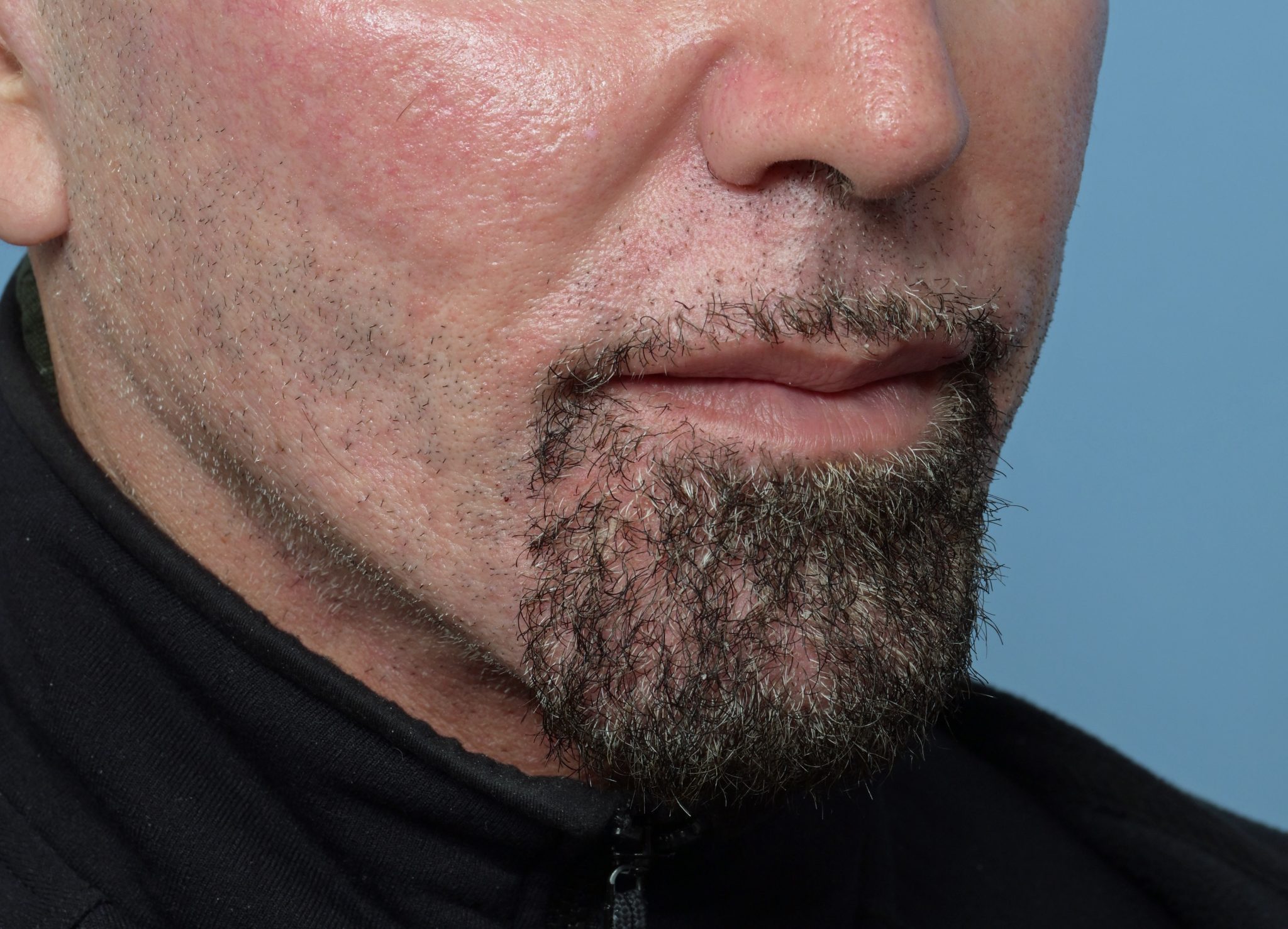 Plastic Surgery Case Study - Custom Chin Implant for Strong Squared ...