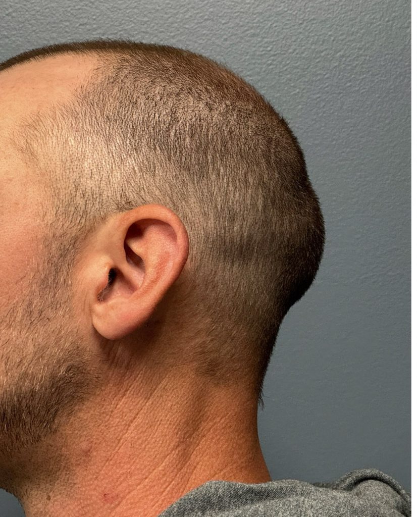 Plastic Surgery Case Study - Occipital Bun Skull Reduction in a Male ...