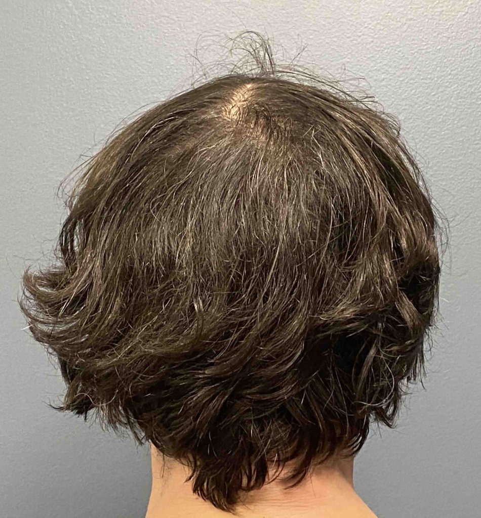 Plastic Surgery Case Study - Top of the Head Skull Reduction - Explore ...