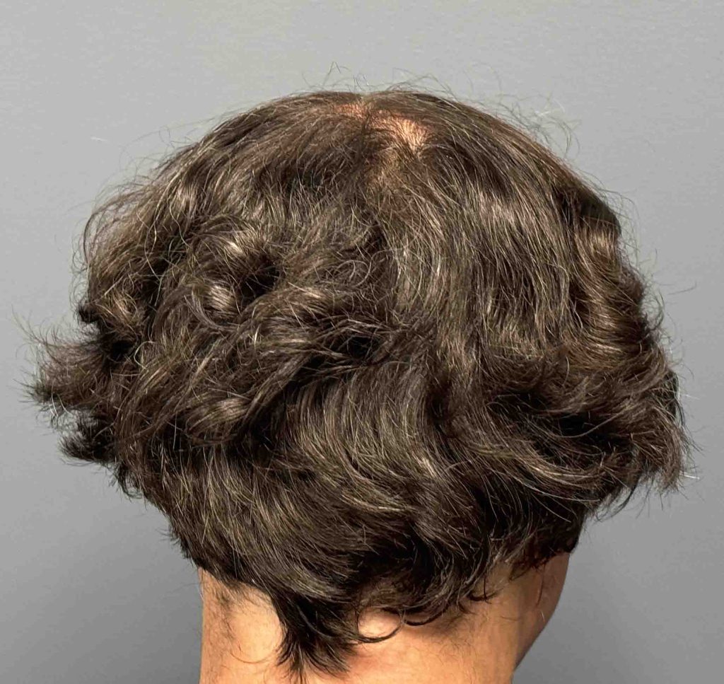 Plastic Surgery Case Study - Top of the Head Skull Reduction - Explore ...