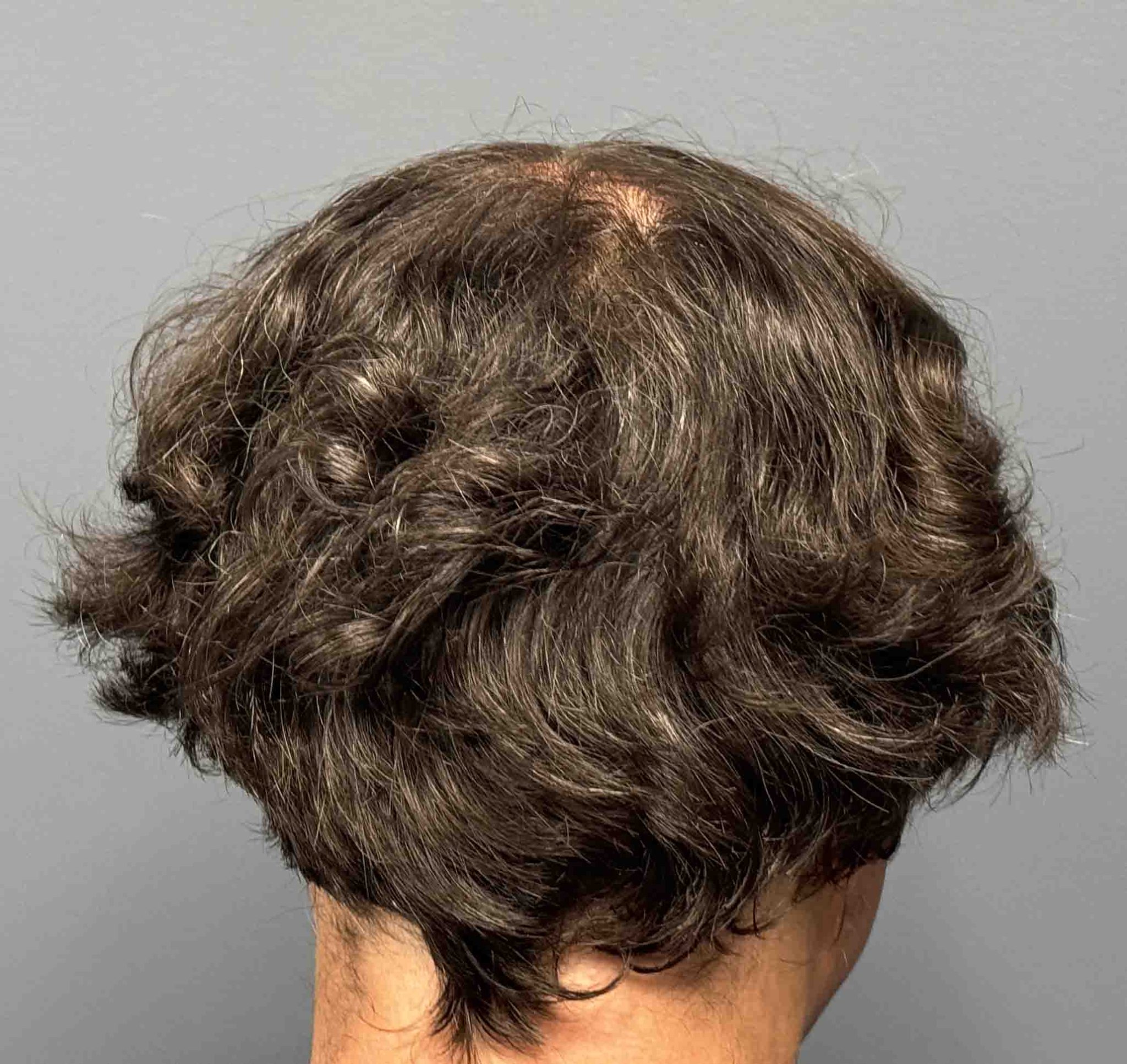 Plastic Surgery Case Study - Top of the Head Skull Reduction - Explore ...