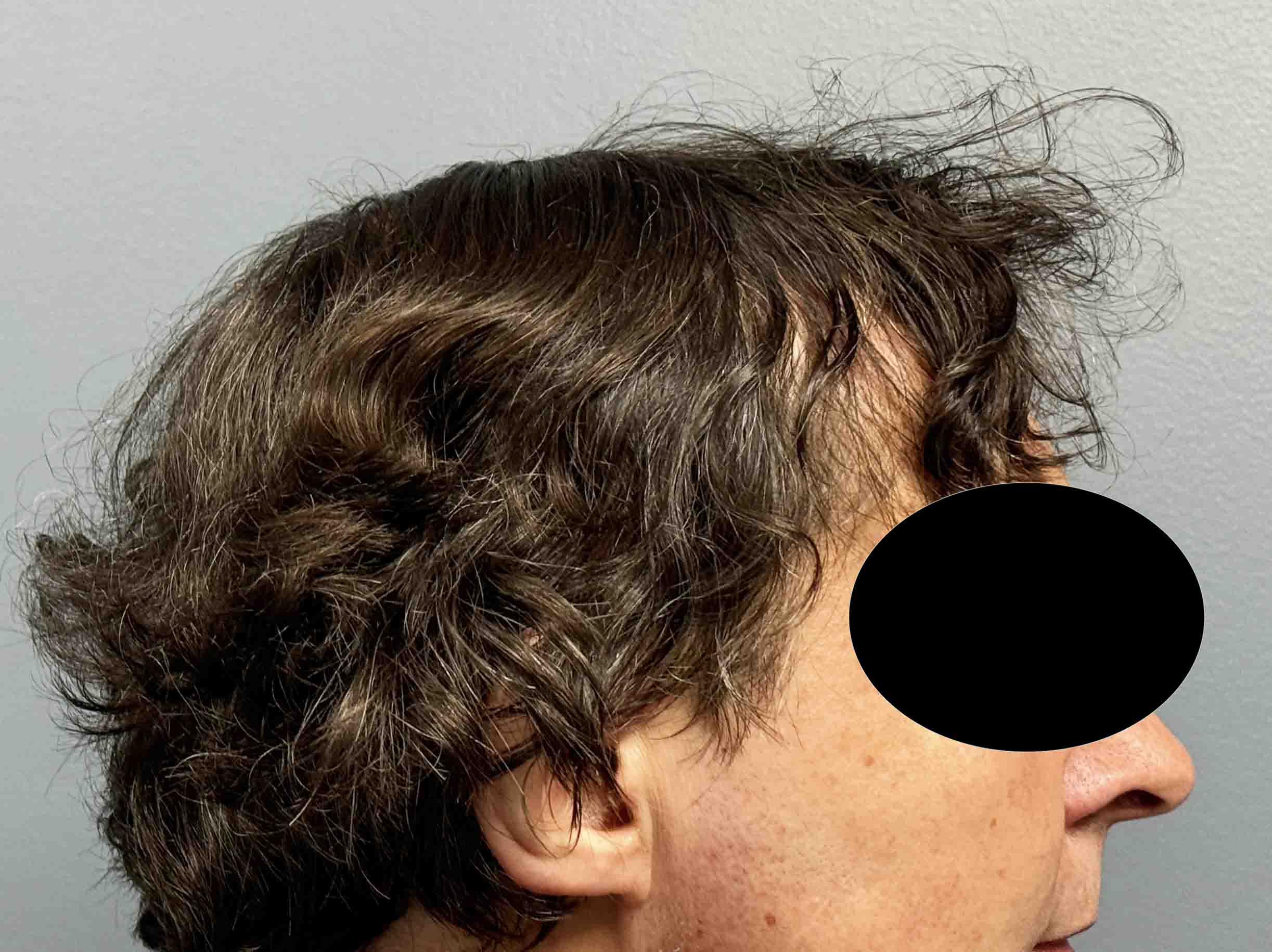 male skull reduction right side 2 Dr Barry Eppley - Explore Plastic Surgery