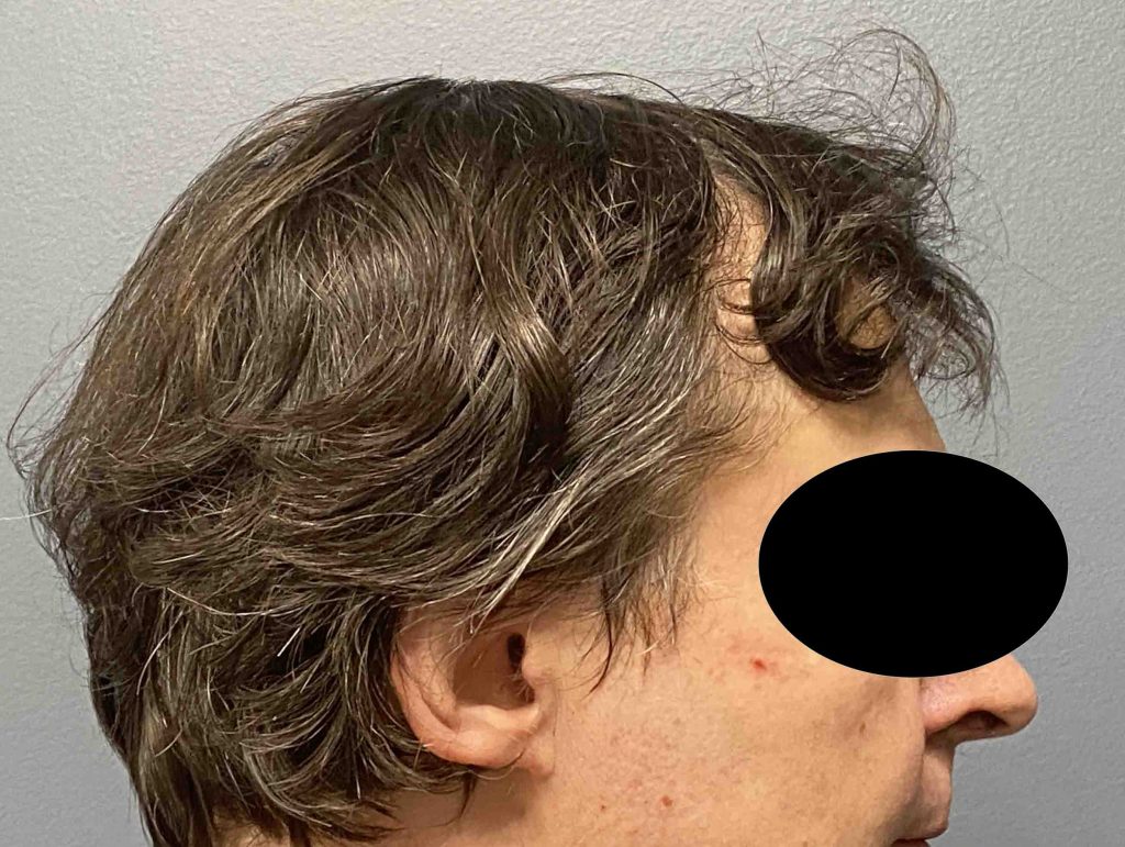 Plastic Surgery Case Study - Top of the Head Skull Reduction - Explore ...