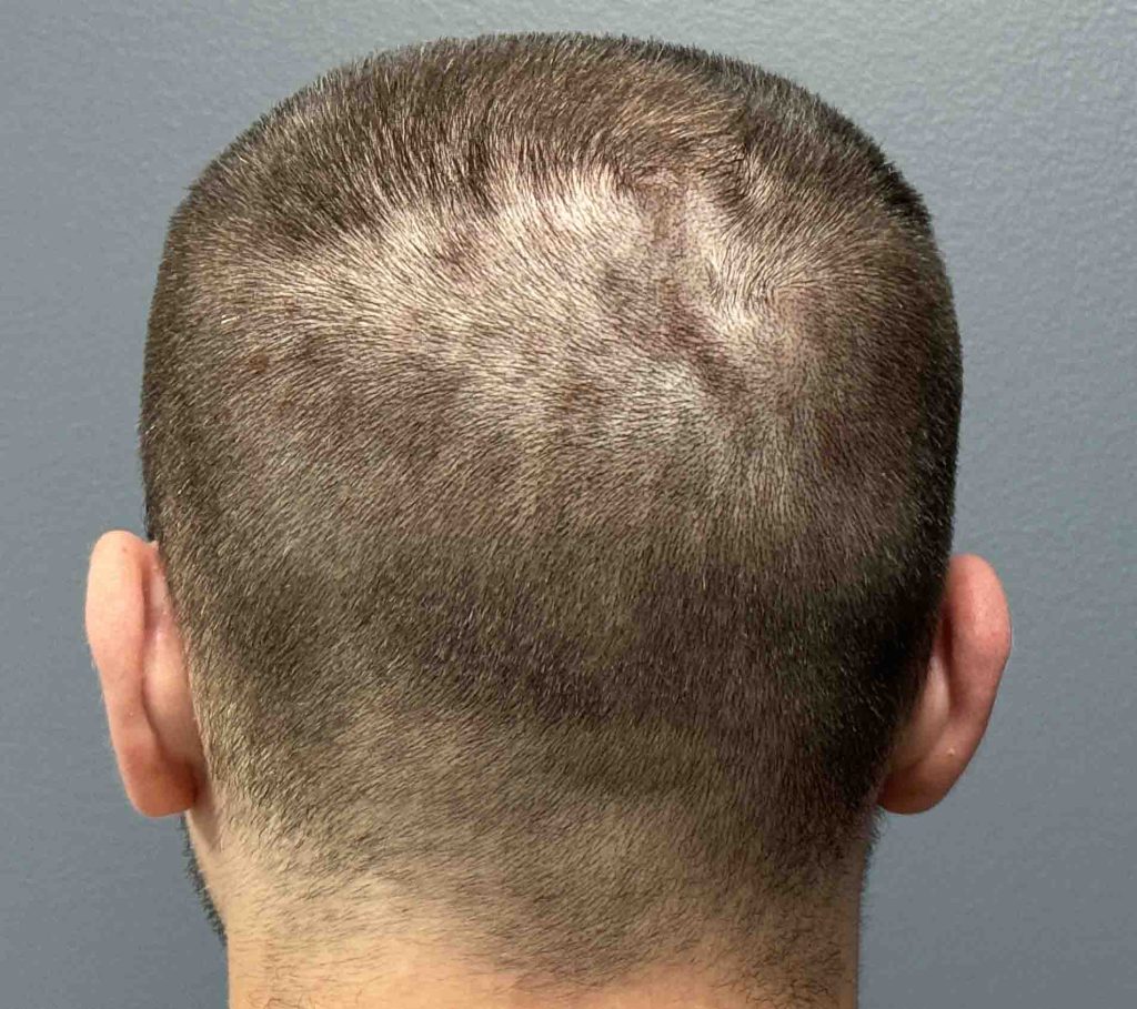 Plastic Surgery Case Study - Secondary Open Vertical Temporal Reduction ...