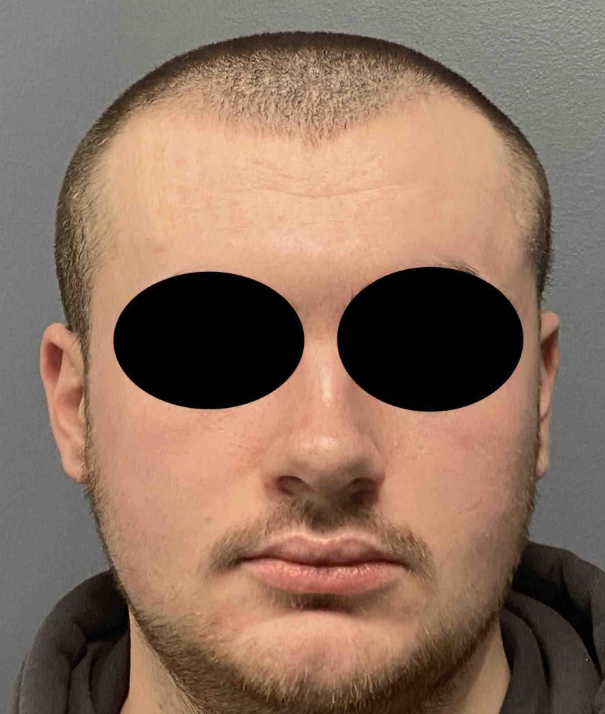 Plastic Surgery Case Study - Long Term Results from Temporal Reduction ...