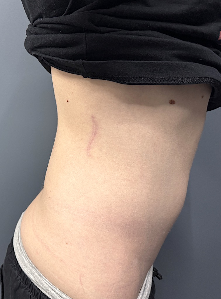 Plastic Surgery Case Study - Long Term Results in Type 2 Rib Removals ...