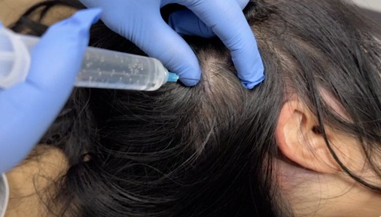 Inflations of Scalp Tissue Expanders in Two Stage Skull Augmentations ...