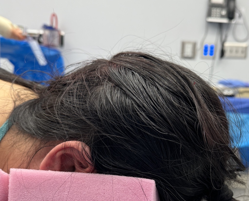 Inflations of Scalp Tissue Expanders in Two Stage Skull Augmentations ...