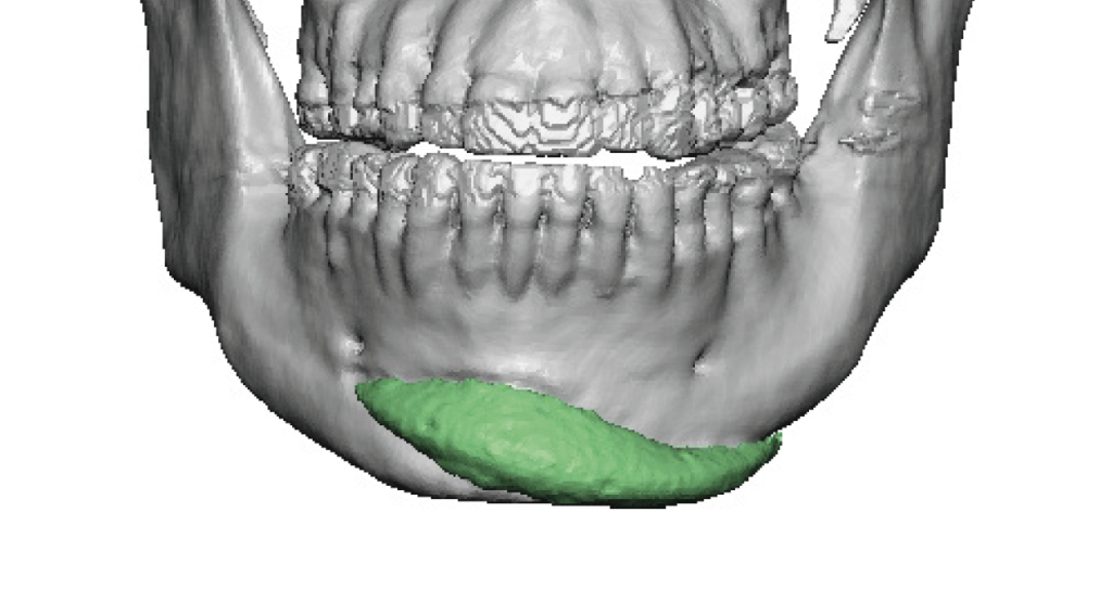 Plastic Surgery Case Study - Custom Chin Implant for Strong Squared ...