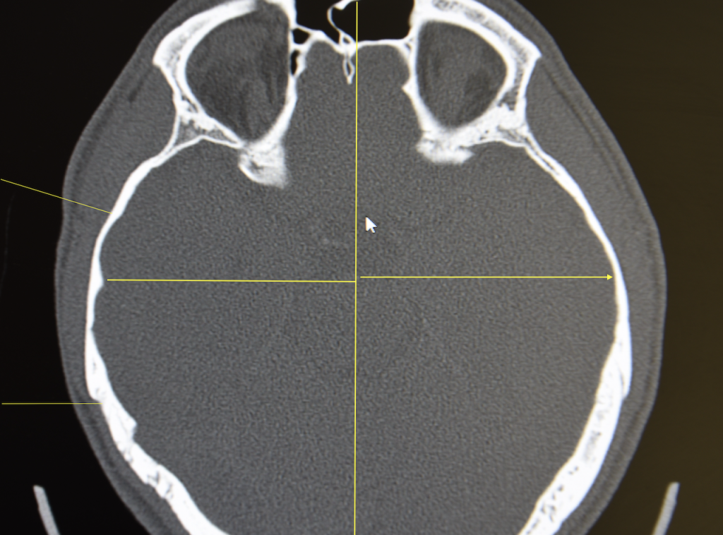 Plastic Surgery Case Study - Long Term Results from Temporal Reduction ...