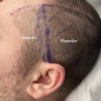 temporal reduction Archives - Explore Plastic Surgery