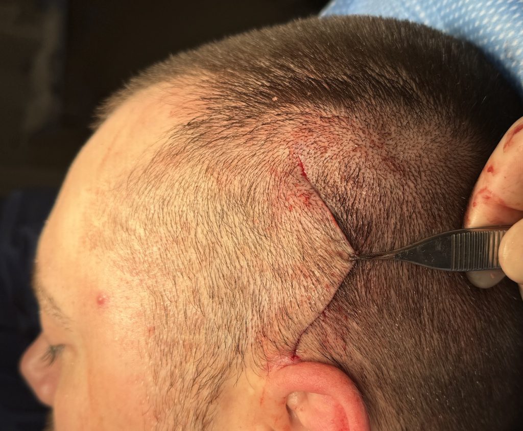 Plastic Surgery Case Study - Secondary Open Vertical Temporal Reduction ...