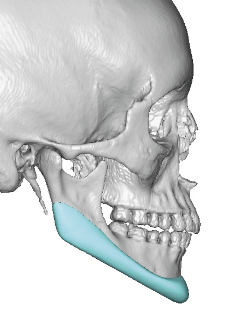 Plastic Surgery Case Study - Female Custom Jawline Implant for Subtotal ...
