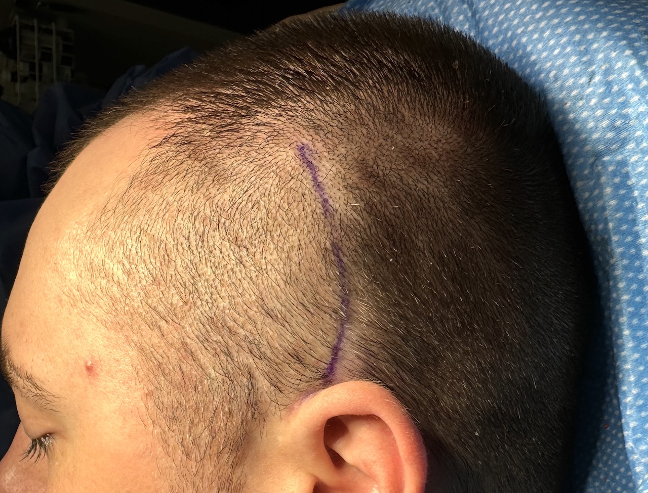 Plastic Surgery Case Study - Secondary Open Vertical Temporal Reduction ...